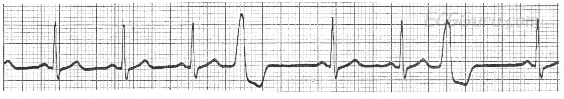 Ecg Basics Normal Sinus Rhythm With Premature Ventricular Contractions Ecg Guru Instructor